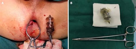 Colonoscopy Assisted Removal Of An Impaction Foreign Body At The