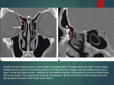 Failed Fess Spectrum Of Ct Findings In The Frontal Recess