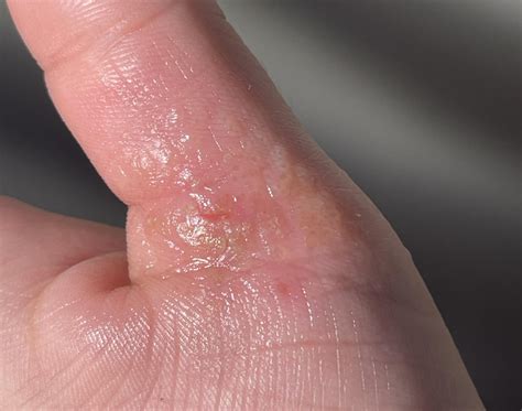 Possible Dyshidrosis Rdyshidrosis