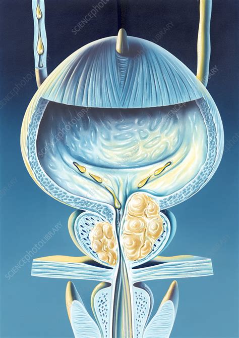 Enlarged Prostate Gland Stock Image M8650225 Science Photo Library