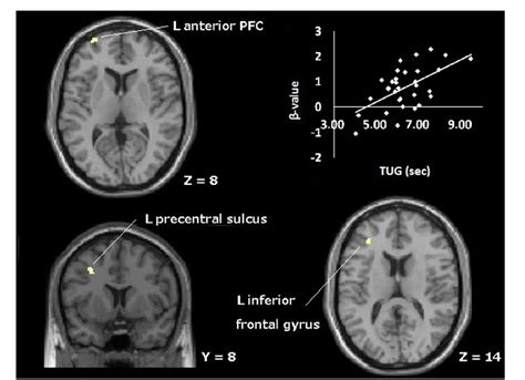 Figure 3 From Brain Activation During Visual Working Memory Correlates