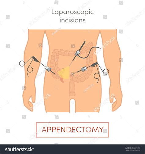 Appendectomy Surgical Removal Appendix Laparoscopic Incisions Stock Vector Royalty Free 360475979