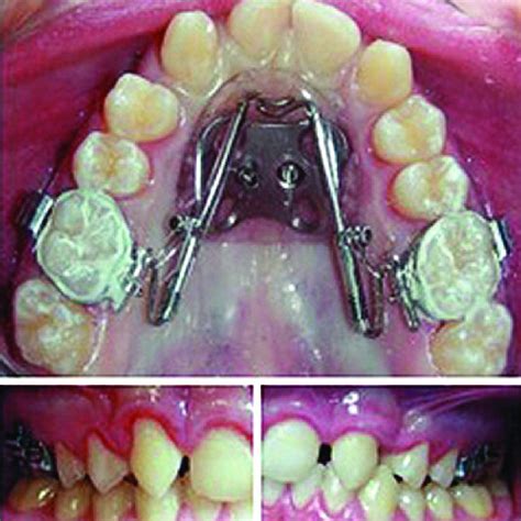 Molar Class Correction After Eight Months Of Treatment With Distal