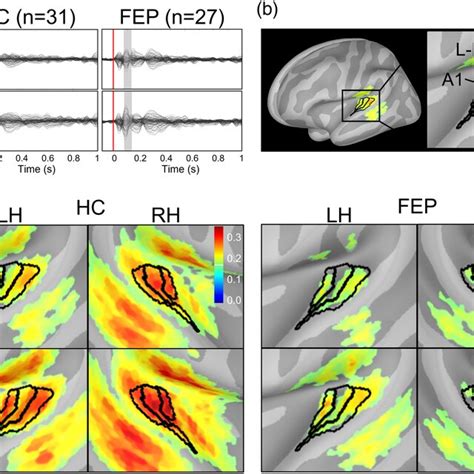 Impaired Auditory Cortex Attention Modulation In First‐episode