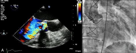 Ecocardiograma Transesofagico Aorta Pseudoaneurisma Sobre Válvula