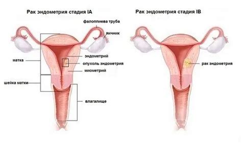 What Is Uterine Hypertonicity Symptoms Diagnosis Treatment Womens