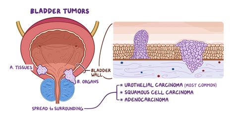 Bladder Cancer Cells