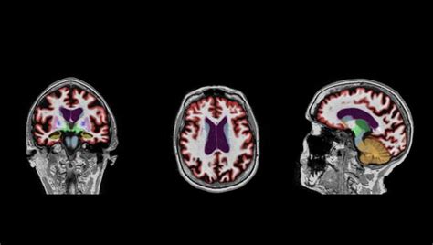 Melanie L Mcnulty On Linkedin Neuroquant 4 0 Improved Segmentation