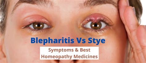 Blepharitis Vs Stye Symptoms And Best Homeopathic Medicines