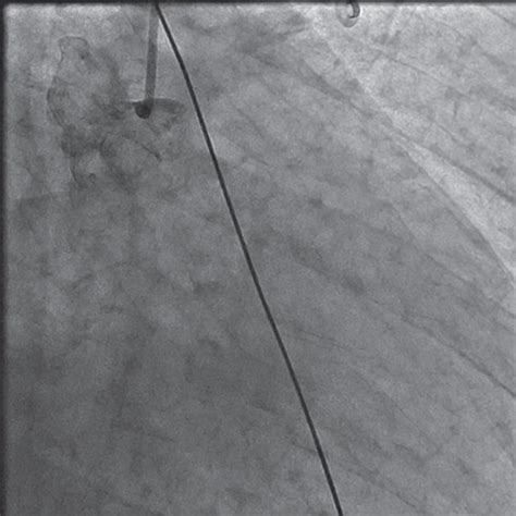 Cardiac Catheterization Showed Total Occlusion Of Lmca Download