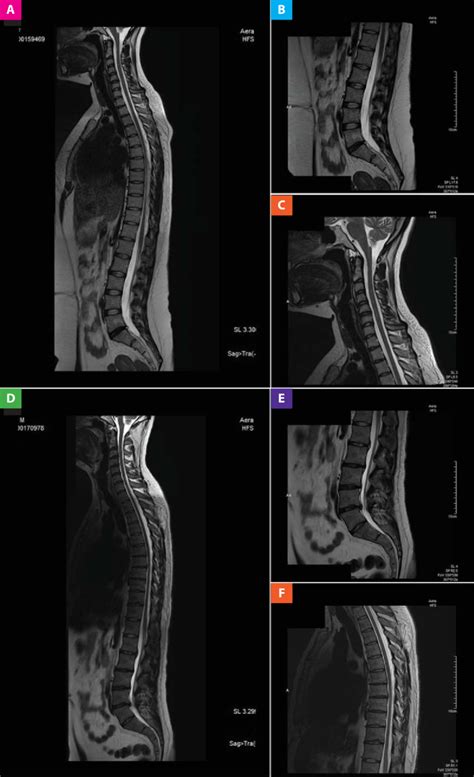 Mri Of 2 Cases With Application Of Panoramic T2 Sequence 1