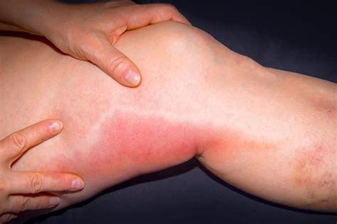 Phlebitis Rash Pictures Symptoms And Pictures