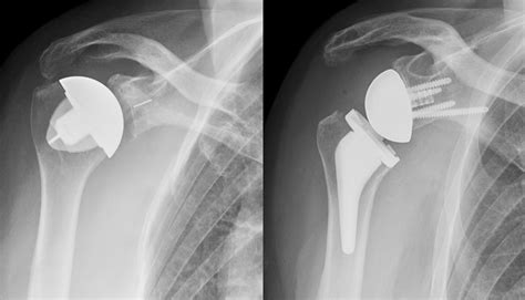 Total Shoulder Arthroplasty Replacement