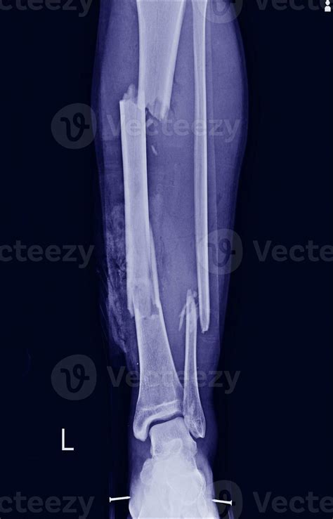 Xray Of Tibia And Fibula Fracture Stock Photo Getty Images