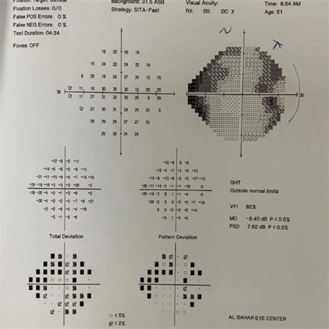The Central 24 2 Humphrey Visual Field Test Of The Right Eye Showed
