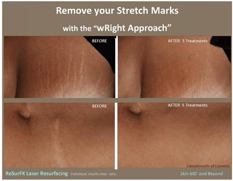 Stretch Marks Treatment Plano Tx Scar Treatment Frisco Tx