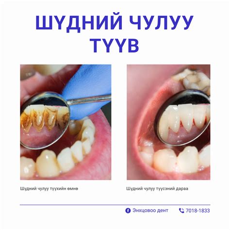 Энхцовоо дент Шүдний чулуу нь олон тооны бактерийг агуулж байдаг учир цэвэрлүүлэхгүй удах нь