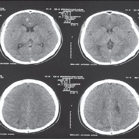 Ct Scan Of Head Shows Diffuse Cerebral Edema Download Scientific Diagram