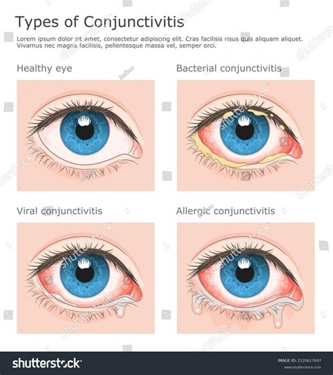 Three Types Conjunctivitis Healthy Eye Medical Stock Vector Royalty