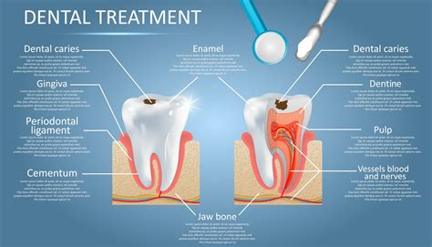 Dental Fillings San Diego Dentist Smile Designers Point Loma