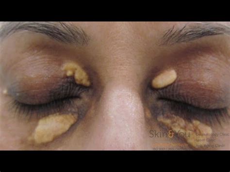 What Do White Under Eyelids Mean