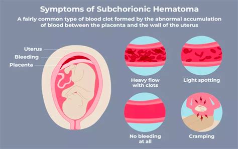 Potential Loss Subchorionic Hematoma Heather Bruce Healing