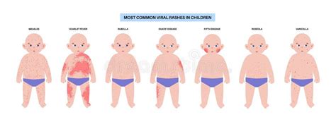 Rash Patterns Stock Illustrations 30 Rash Patterns Stock