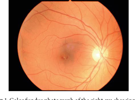 Roth Spots Endocarditis