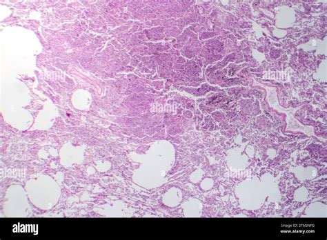 Photomicrograph Of Interstitial Pneumonia Showing Inflammation And
