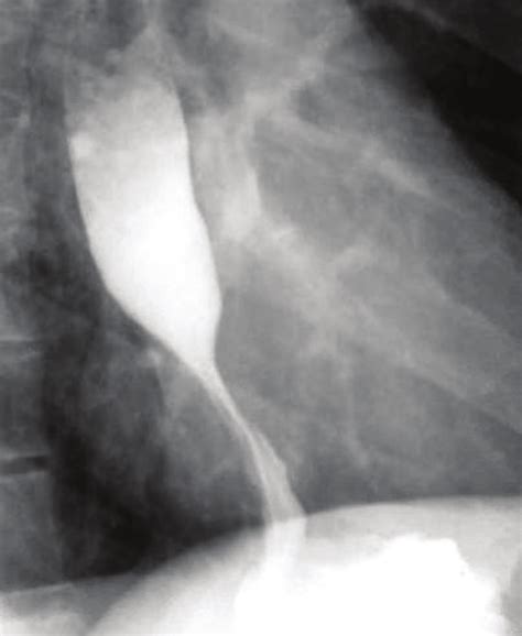 Pre Operative Esophagram Demonstrating Distal Esophageal Narrowing At
