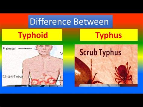 Typhus Definition Symptoms Treatment And More 59 Off