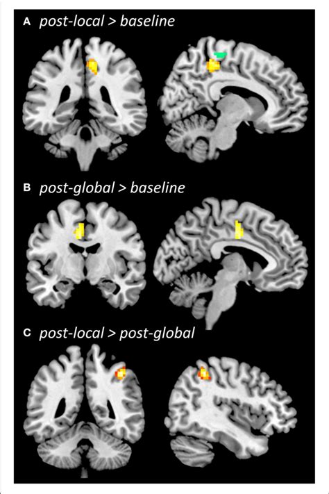 Regional Homogeneity Reho During Resting State Whole Brain Download Scientific Diagram