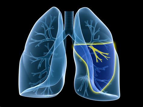 Surgical Videos Robotic Surgery — Robotic Thoracic Surgery