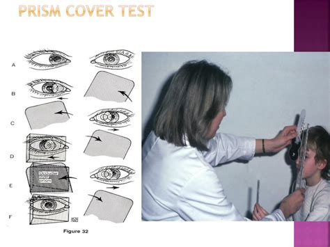 Ppt Strabismus Powerpoint Presentation Free Download Id4244910