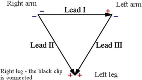Einthovens Triangle Download Scientific Diagram