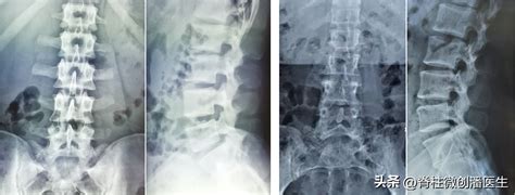 What Problems Will Lumbar Sacralization And Sacral Lumbarization Cause Inews