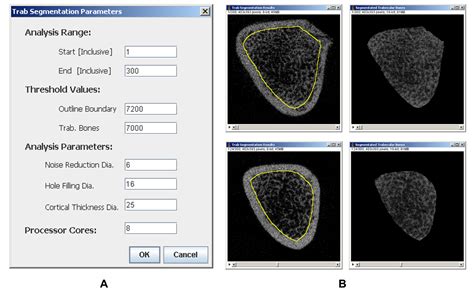 outer boundary assisted segmentation and quantification of trabecular