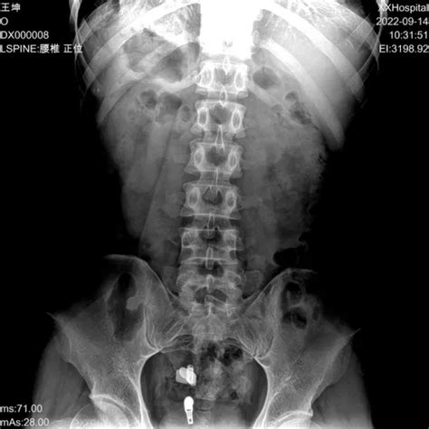 Digital Radiopgraphy X Ray Radiography System With Factory Price And