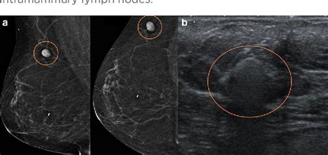 Intramammary Lymph Nodes Normal And Abnormal Multimodality Imaging Features Semantic Scholar
