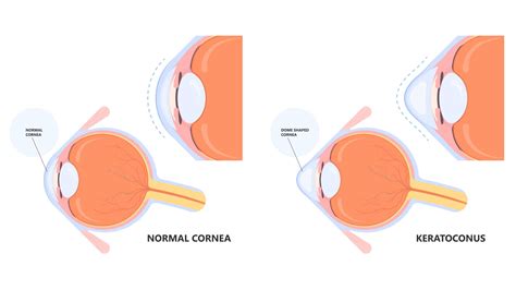 What Is Keratoconus Understanding Symptoms Causes And Treatment