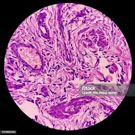 연조직 사구체 종양 또는 부신경절종 현미경으로 연조직 Glomus 종양의 특징 양성이지만 국소 침습성 종양을 보여줍니다 건강