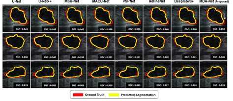 Breast Lesion Segmentation Result Of Three Randomly Selected Samples Download Scientific