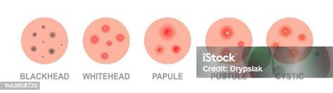 여드름의 종류 스킨 케어 문제 및 염증 여드름 피부 유형 여드름 화이트 헤드 구진 농포 낭성 및 결절성 여드름에 대한 스톡 벡터 아트 및 기타 이미지 Istock