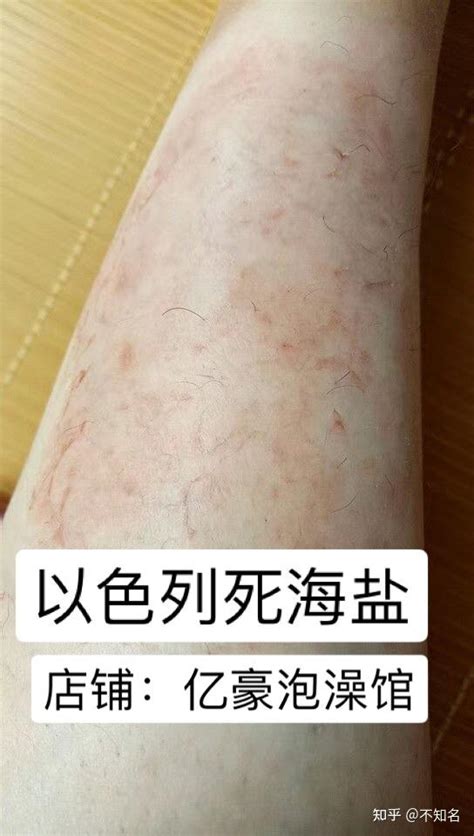 死海盐治疗牛皮癣 知乎