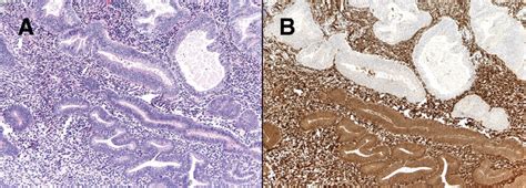 A Disordered Proliferative Endometrium Shows B Loss Of Pten