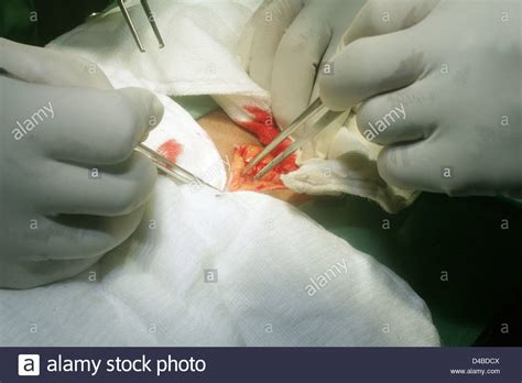 Inflammation Appendix Usually Affects Younger People Chief Symptom