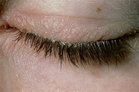 Blepharitis Demodex Learn More Today — Sunshine Optometry
