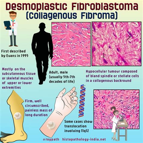 Desmoplastic Fibroblastoma Collagenous Fibroma Pathology Human