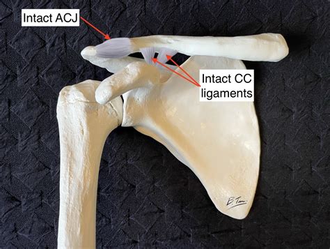 Acromioclavicular Joint Dislocation Specialist Dr Bryan Tan