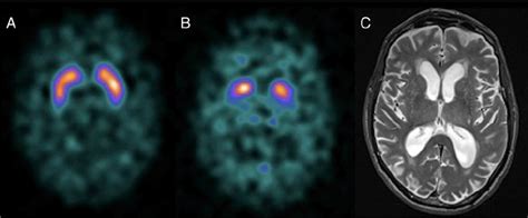 normal dat scan a for comparison dat scan of a patient with dlb